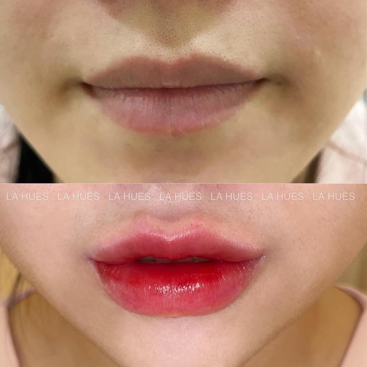 Cân Chỉnh HA Hàn