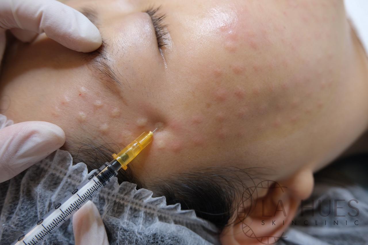 Acnes Therapy - Điều trị Mụn